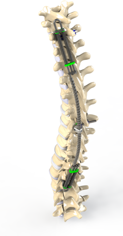 Double Spring Reduction system - Thematische Technologie Transfer
